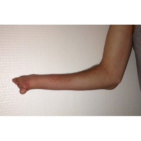 Adaptations pour une agénésie du bras